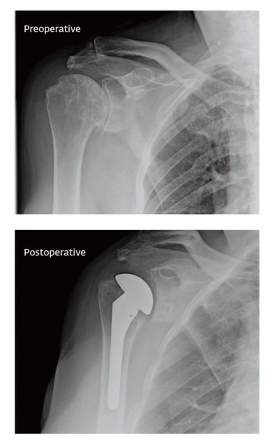 Total Shoulder Replacement - Dr Bryan Bomberg