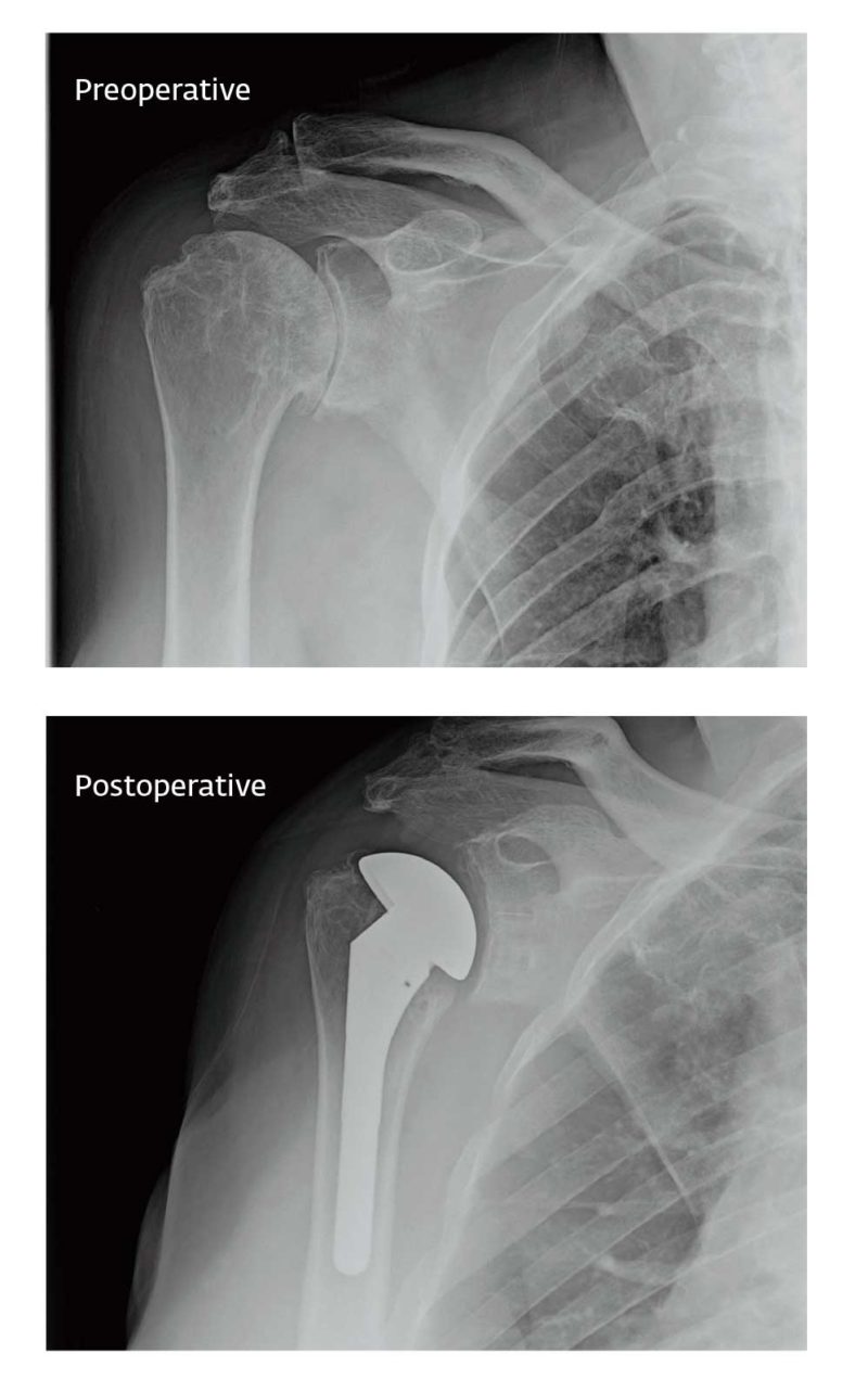 Total Shoulder Replacement - Dr Bryan Bomberg